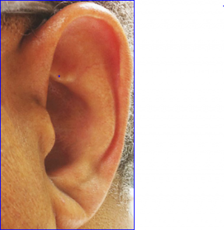 Propensão a Infarto olhando só a orelha é possível? descubra o que é ...